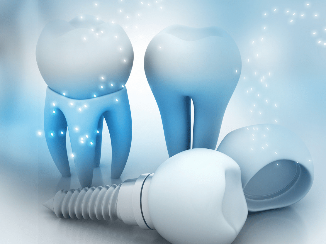 Zygomatic Dental Implants in New Jersey | Dr. Alan Meltzer DMD